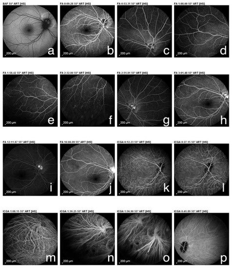 Juxtapapillary Choroidal Neovascularization in a Young Woman with ...