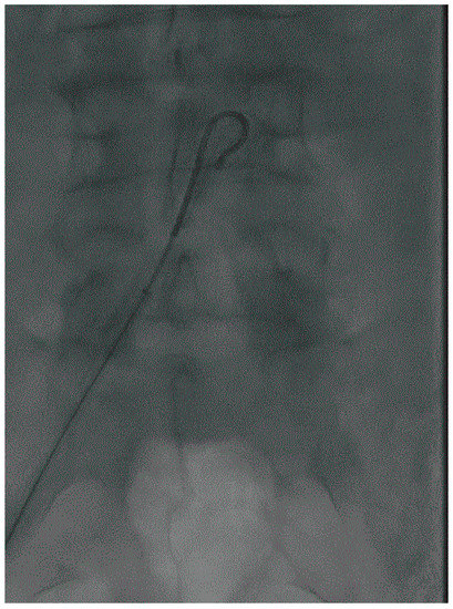 Algorithm of Femoropopliteal Endovascular Treatment