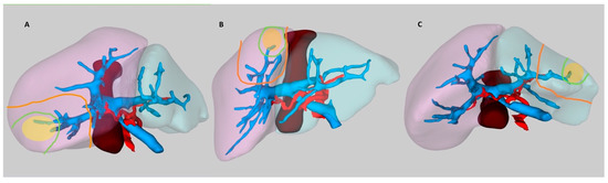 Comparison of Anatomic and Non-Anatomic Liver Resection for Hepatocellular Carcinoma: A ...