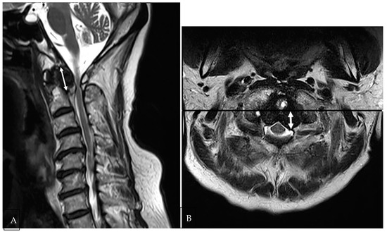 Imaging Characterization of Non-Rheumatoid Retro-Odontoid Pseudotumors ...