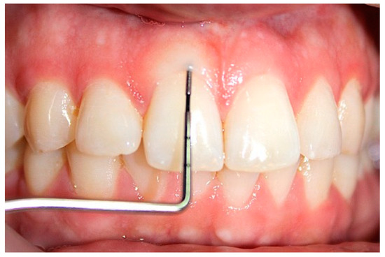 A Comparative Evaluation of Dentogingival Tissue Using Transgingival ...