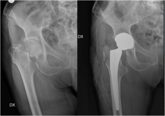 Proximal Femoral Fractures in the Elderly: A Few Things to Know, and ...