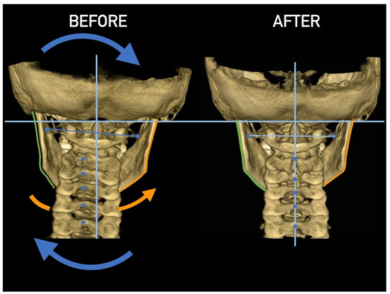Neural Basis of Etiopathogenesis and Treatment of Cervicogenic ...