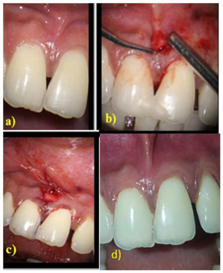 Interdental Papillary Reconstruction by Microtunnelling Technique Using ...
