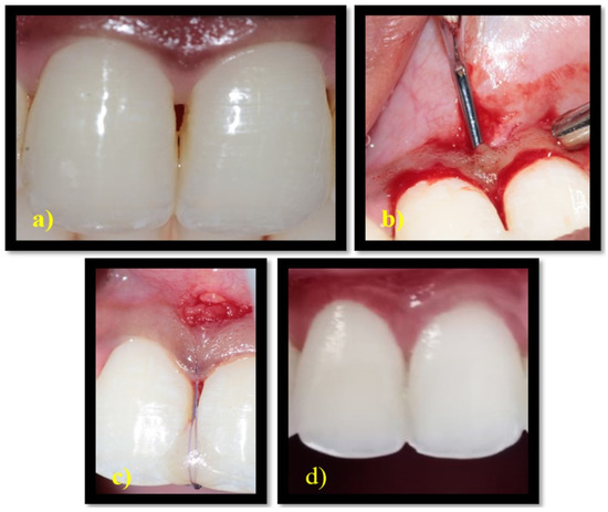 Interdental Papillary Reconstruction by Microtunnelling Technique Using ...