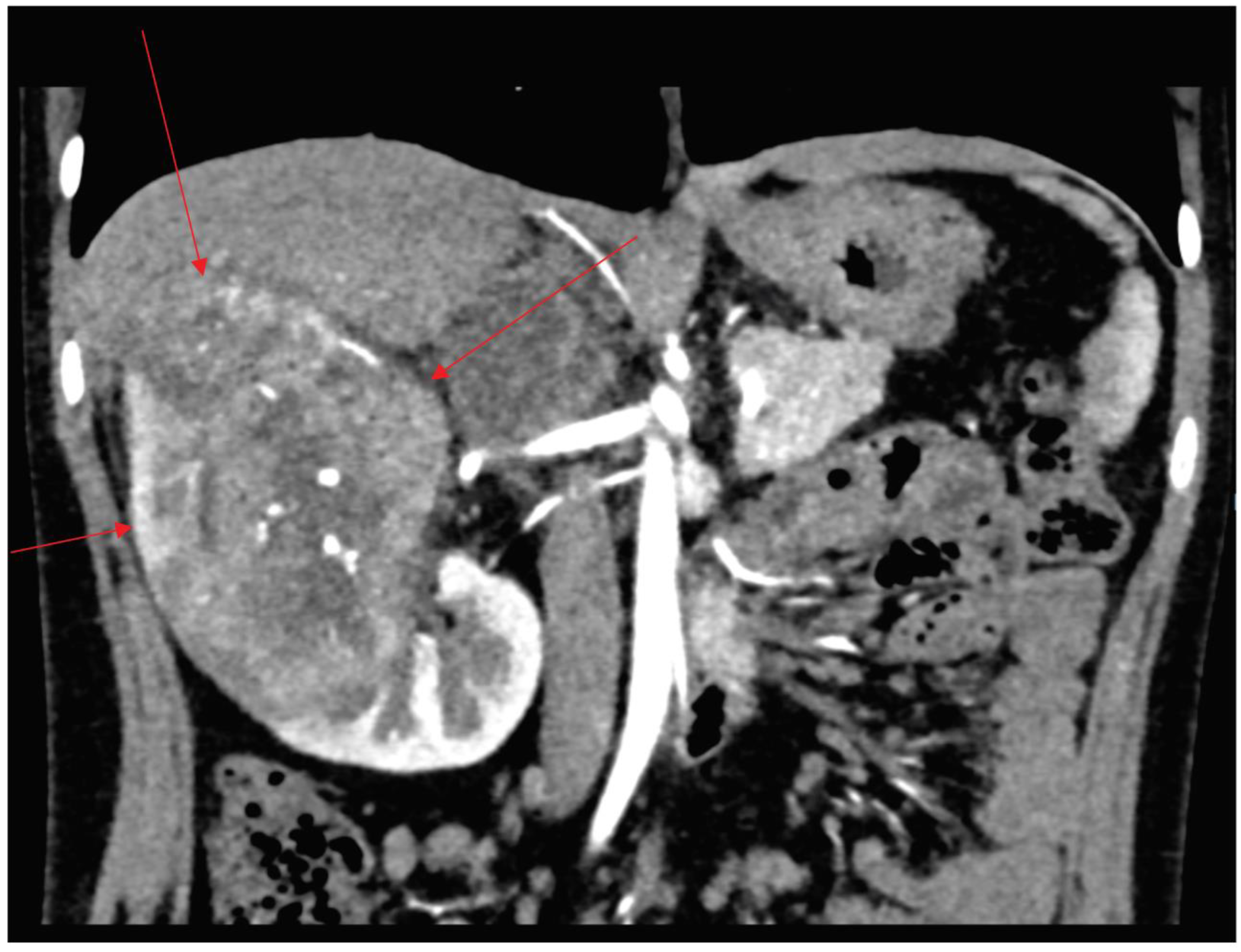 Clear Cell Renal Cell Carcinoma, Diagnostic and Therapeutic ...