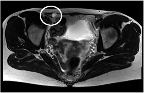 The Cyst of the Canal of Nuck: Anatomy, Diagnostic and Treatment of a ...
