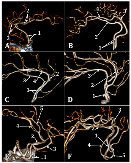 Transcallosal and Pericallosal Courses of the Anterior Cerebral Artery