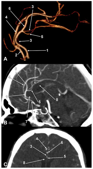 Transcallosal and Pericallosal Courses of the Anterior Cerebral Artery