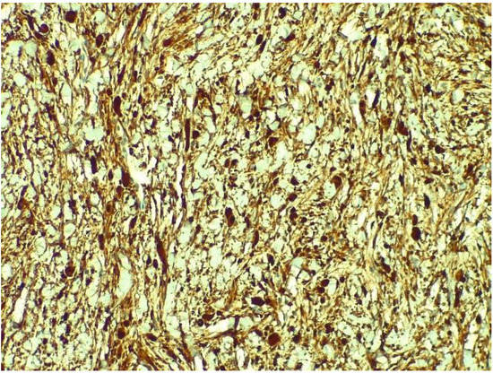 A Rare Case of Left Ventricular Malignant Peripheral Nerve Sheath ...