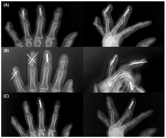 The Inlay Technique with Cortico-Cancellous Olecranon Bone Graft Used ...