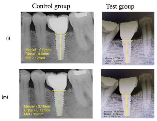 The Effect of Laser Micro Grooved Platform Switched Implants and ...
