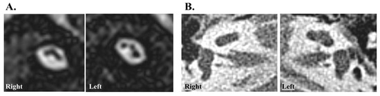 Medicina | Free Full-Text | Functional Outcomes of Cochlear ...