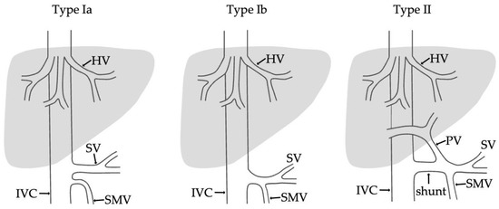 Congenital Absence of the Portal Vein as a Rare Cause of Portopulmonary ...