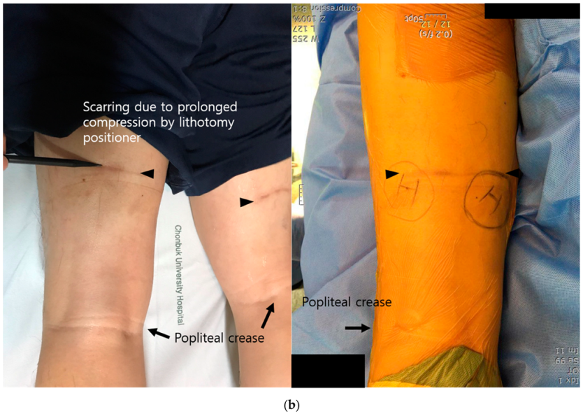 Open Sciatic Nerve Decompression for Compartment Syndrome after ... Open Sciatic Nerve Decompression for Compartment Syndrome after ...