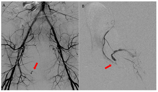 Successful Interventional Management of Life-Threatening Bleeding after ...