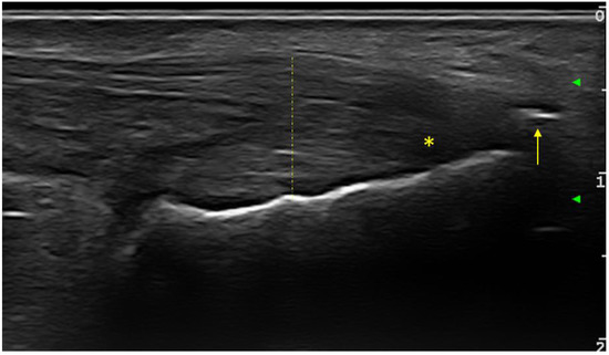 Ultrasound Enthesitis in Psoriasis Patients with or without Psoriatic ...