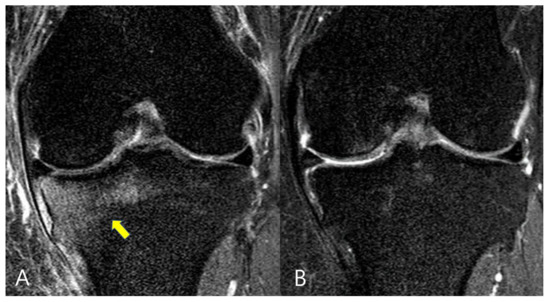 Changes in Bone Marrow Lesions Following Root Repair Surgery Using ...