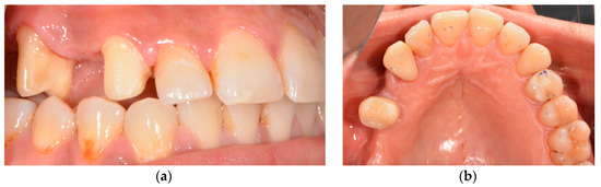 Digital Workflow for Implant Placement and Immediate Chairside ...