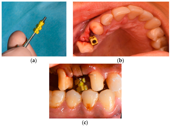 Digital Workflow for Implant Placement and Immediate Chairside ...