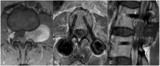 Medicina | Free Full-Text | Minimally Invasive Facetectomy and Fusion ...