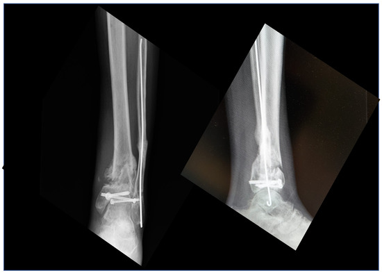 Custom-Made Implants in Ankle Bone Loss: A Retrospective Assessment of ...