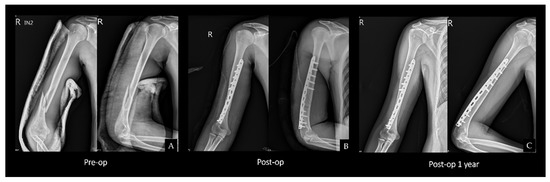 Clinical Outcomes of Single Versus Double Plating in Distal-Third ...