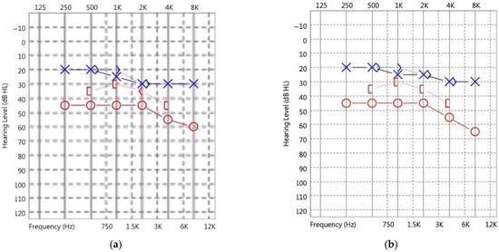 Patient with Aberrant Internal Carotid Artery in the Middle Ear ...