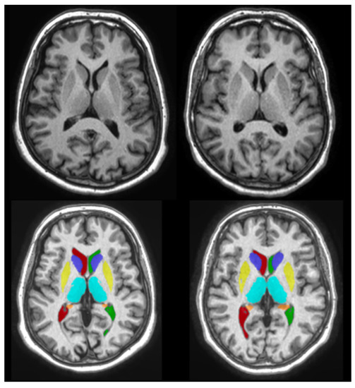 Heritability of Subcortical Grey Matter Structures