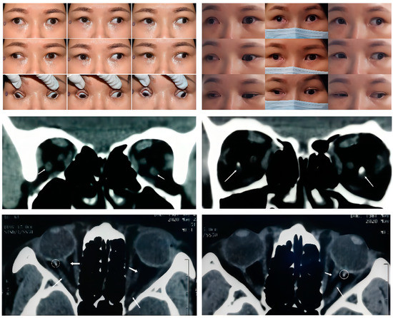 Supernumerary Extraocular Muscle: A Rare Cause of Atypical Restrictive ...