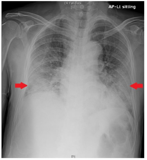 Effectiveness of Mesenchymal Stem Cell Therapy for COVID-19-Induced ...