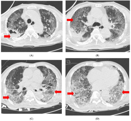 Effectiveness of Mesenchymal Stem Cell Therapy for COVID-19-Induced ...