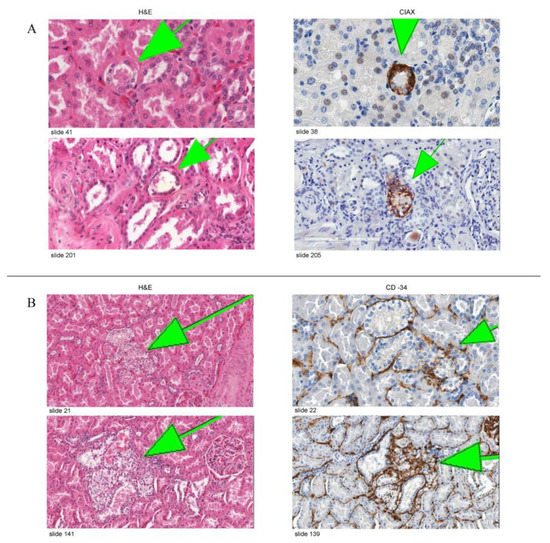 Characterization of Microscopic Multicellular Foci in Grossly Normal ...
