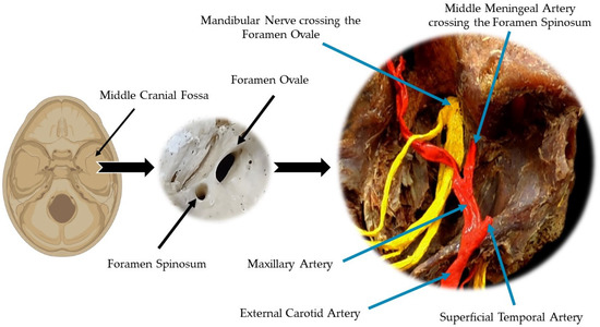 Medicina | Free Full-Text | Topographic and Morphometric Study of the Foramen Spinosum of the ...