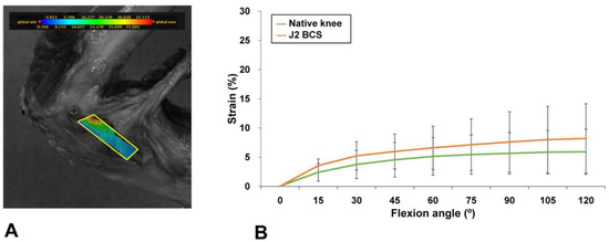 Guided-Motion Bicruciate-Stabilized Total Knee Arthroplasty Reproduces ...