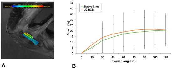 Guided-Motion Bicruciate-Stabilized Total Knee Arthroplasty Reproduces ...