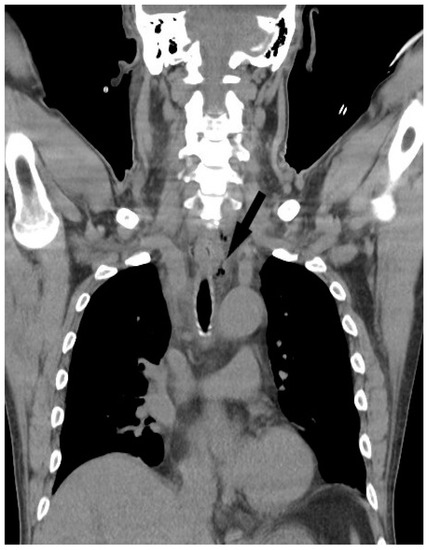 Risk Factors of Descending Necrotizing Mediastinitis in Deep Neck Abscesses