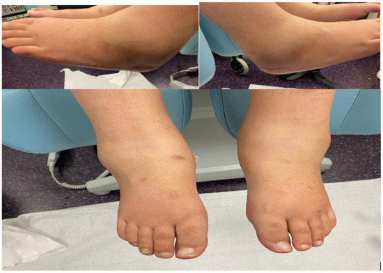 Delayed Diagnosis of Bilateral Neuroarthropathy: Serious Impact on the ...