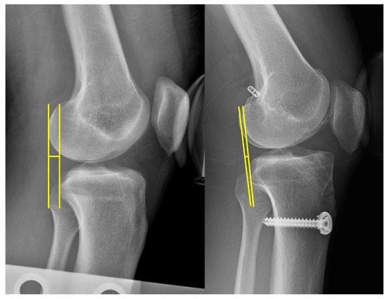 Comparison of Clinical and Radiographic Outcomes According to the ...