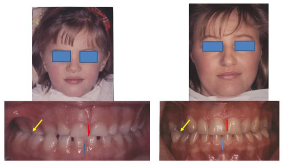 Temporomandibular Joint and Otitis Media: A Narrative Review of ...