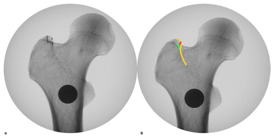 High Percentage of Complications and Re-Operations Following Dynamic ...