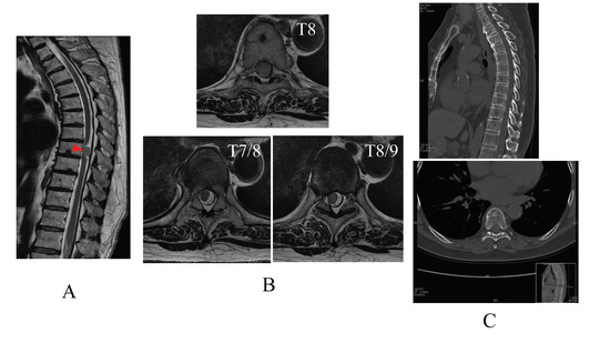 Postoperative Acute-Phase Gait Training Using Hybrid Assistive Limb ...