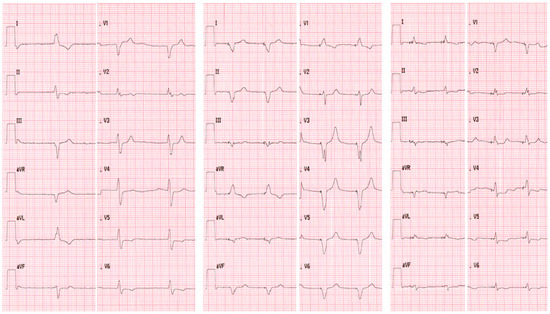 HOT CRT—The Effective Combination of Conventional Cardiac ...