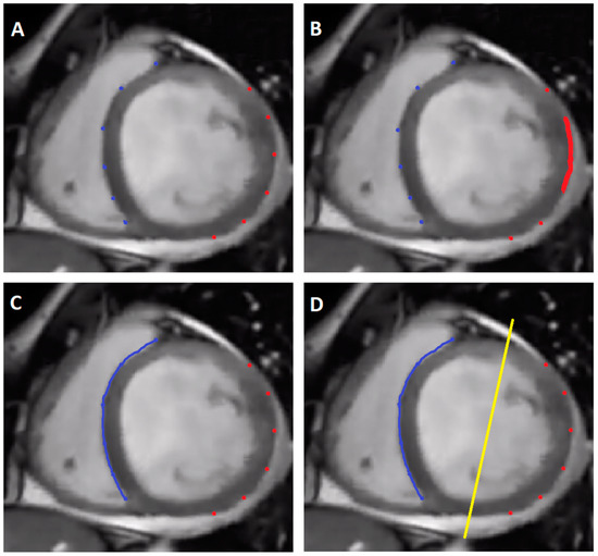 HOT CRT—The Effective Combination of Conventional Cardiac ...