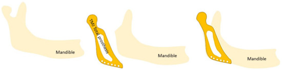 Osteoarthritis of the Temporomandibular Joint: A Narrative Overview