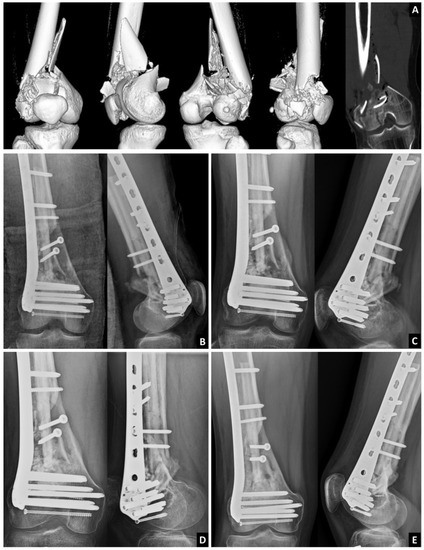 Use of an Intramedullary Allogenic Fibular Strut Bone and Lateral ...