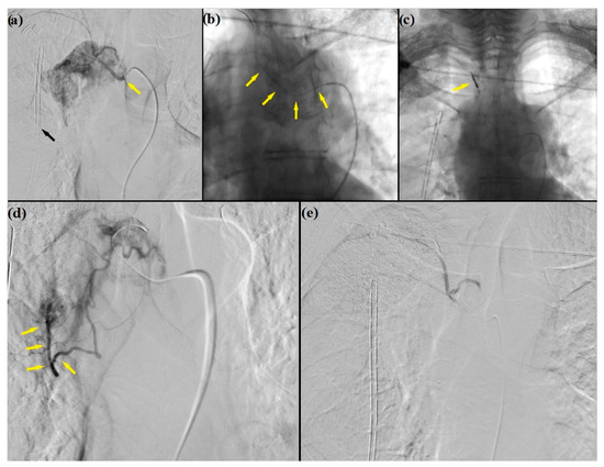 Refractory Chylothorax Secondary to Sizeable Azygos Vein Hemangioma ...