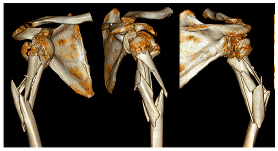 Combined Humeral Head and Shaft Fractures: Outcome Following ...