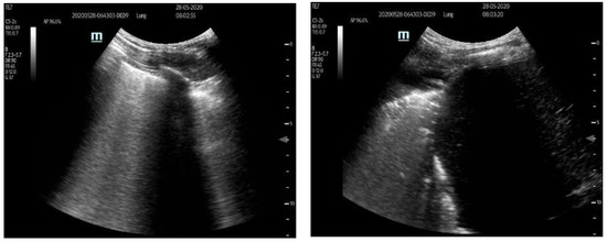 Segmental Lung Recruitment in Patients with Bilateral COVID-19 ...