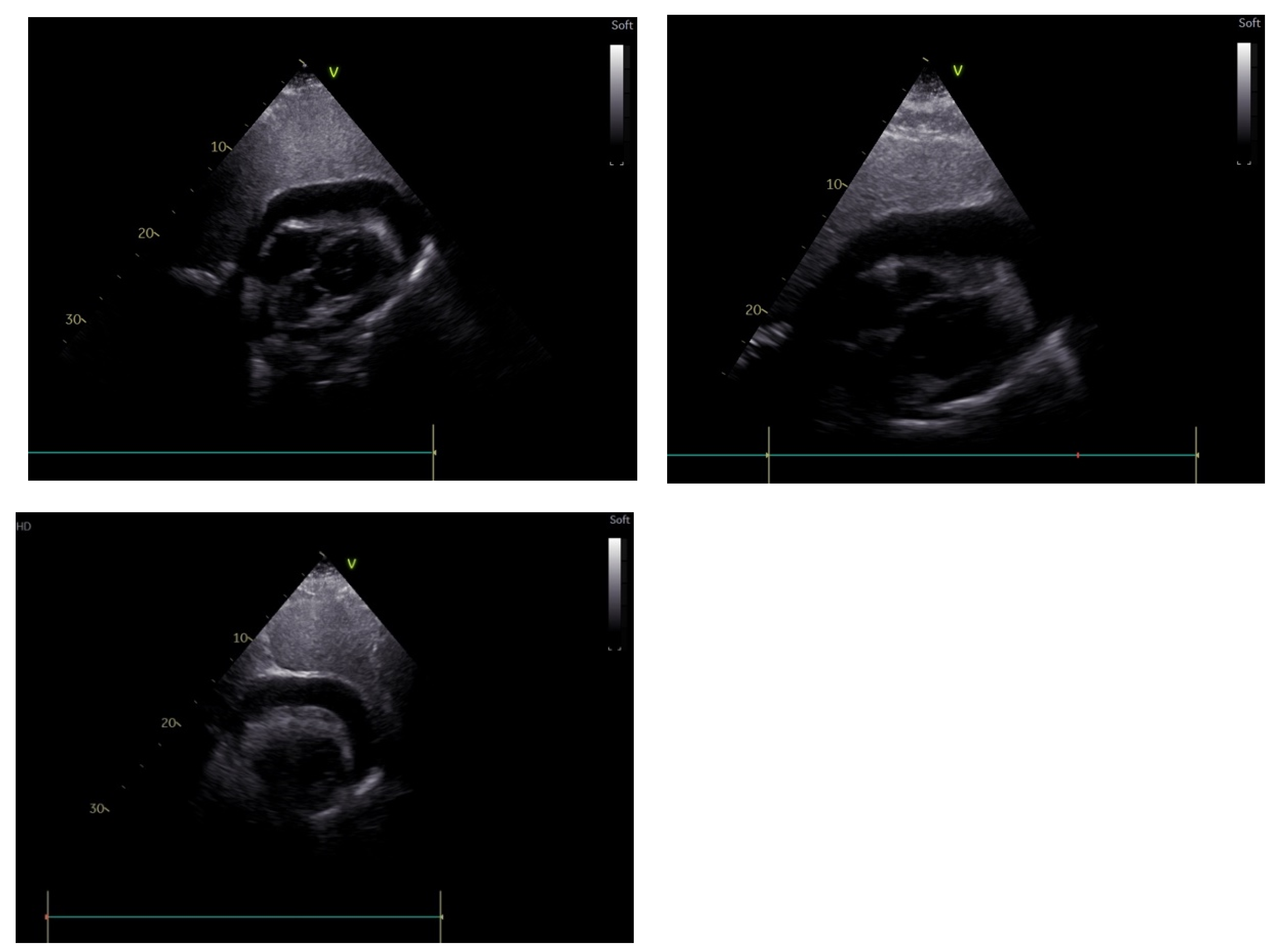 A Rare Case of Primary Purulent Pericarditis Caused by Streptococcus ...